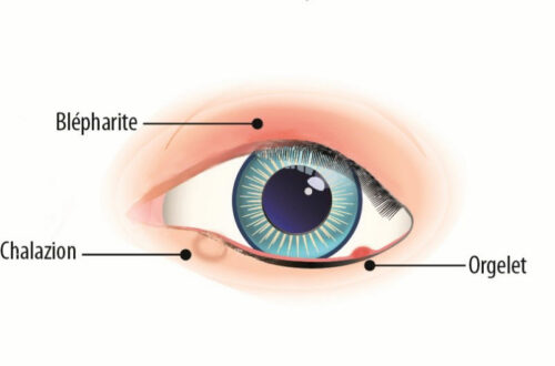 Blépharite : comment soulager un orgelet dur et douloureux